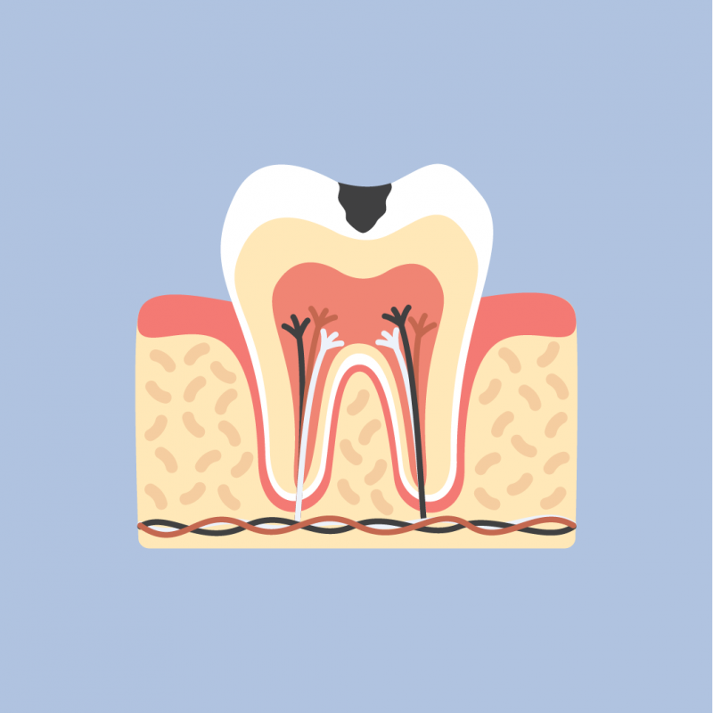 Progression of Decay - Sebastopol Dental Care